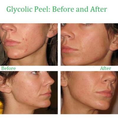 NEW 70% GLYCOLIC ACID Chemical Peel Kit Medical Grade