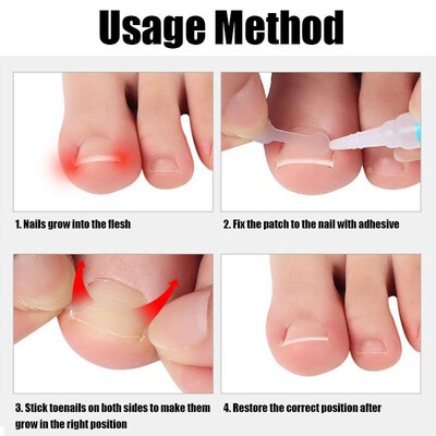 10pc/box Ingrown Toenail Correction Tool Straightening Clip
