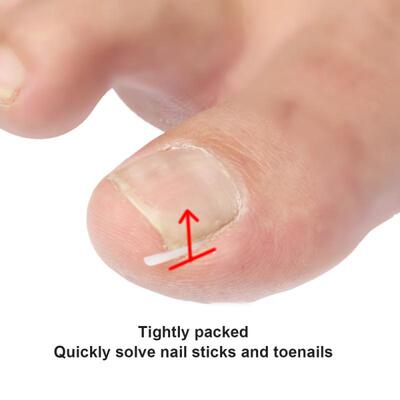 Ingrown+Toenail+Correction+Pads+Ingrown+Nail+Pad+Silicone+In