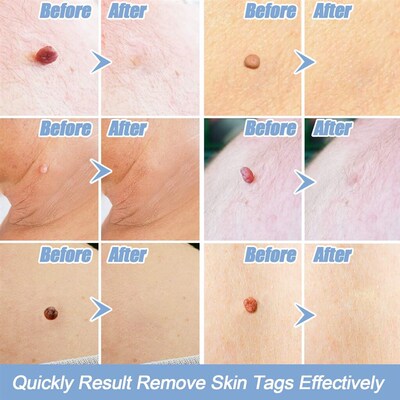 Auto Skin Tag Remover Painless Mole Wart Remover Skin Tag Re