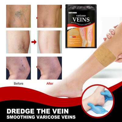 Venous health patch relieves varicose feet 静脉保健贴