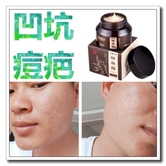 祛儿童点痣痘印痘坑小凹陷修复工具去凹坑精华霜再生痘疤痕灵控油