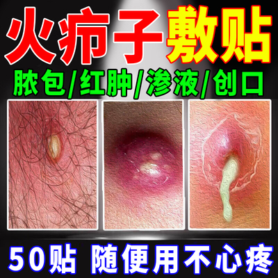 【火疖子无菌敷料贴】吸脓拔脓贴