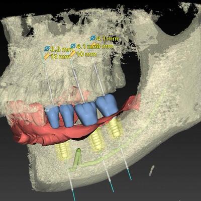 Mimics血管肺肝心脏各器官CT或MRI三维重建3dslicer vtk itk代做