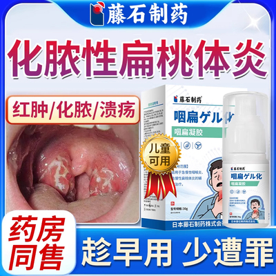藤石制药扁桃体发炎咽喉肿痛