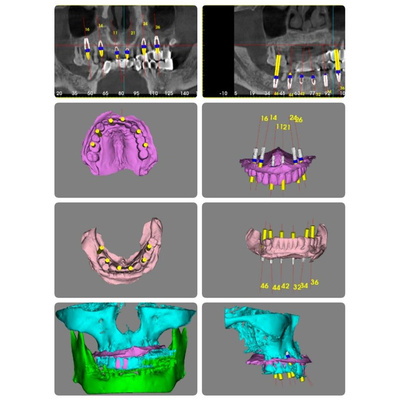 MIMICS医学影像处理CT MRI三维重建模分割生物力学‌FEA分析代做