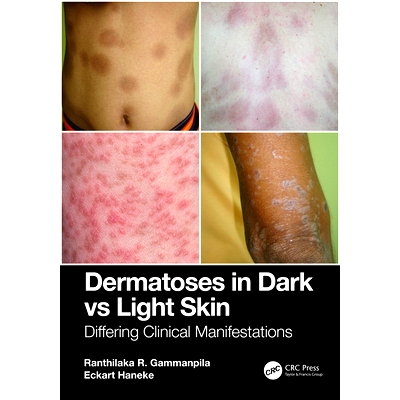 预订 Dermatoses in Dark Vs Light Skin: Differing Clinical Manifestations 深色皮肤与浅色皮肤的皮肤病：不同的临床表现: 978