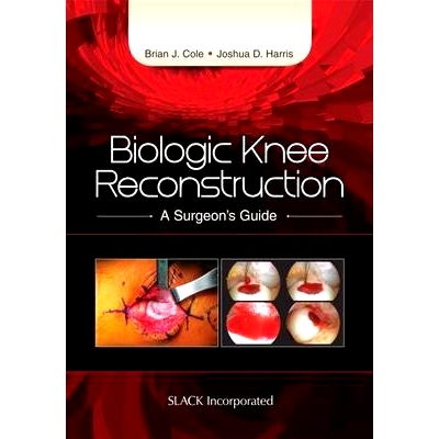 预订 Biologic Knee Reconstruction: A Surgeon’s Guide 生物膝盖再造: 9781617118166