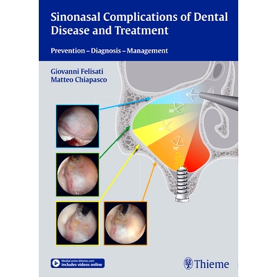 预订 Sinonasal Complications of Dental Disease and Treatment: Prevention - Diagnosis - Management 以下的牙科*鼻腔鼻窦