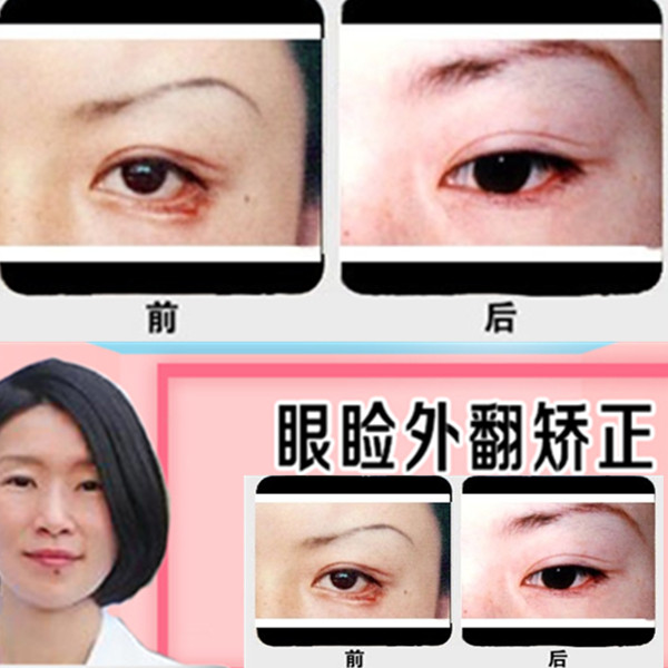 草本眼睑外翻修复精华 改善凹陷饱通经络按摩油精油紧致提拉滋养