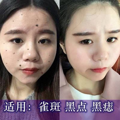 点痣点斑药水去雀斑痦子无痛