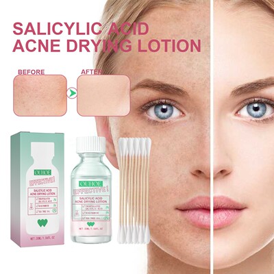 OUHOE Salicylic Acid Acne Lotion - Gentle Repair for Acne-Pr