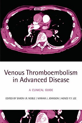 【预售】Venous Thromboembolism in Advanced Disease