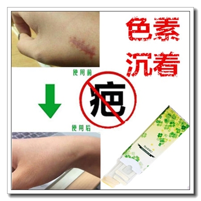 嘴角发黑色素祛儿童烫烧伤药膏修复陈旧老疤痕灵去除红印硅酮凝胶