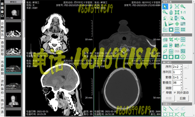 CT工作站软件CT软件MRI核磁软件DSA数字胃肠软件放射科pacs软件