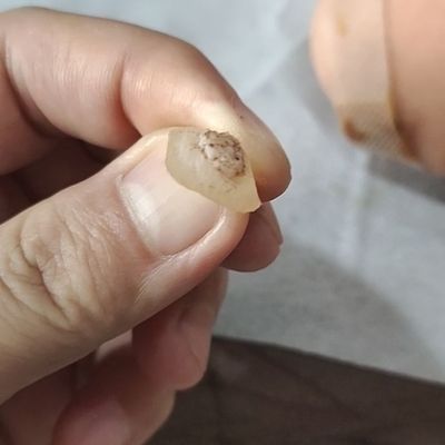 去除手足部手茧肉刺黑痣点斑脚茧疙瘩老鼠痣老鼠奶鱼鳞痣肉痣肉粒