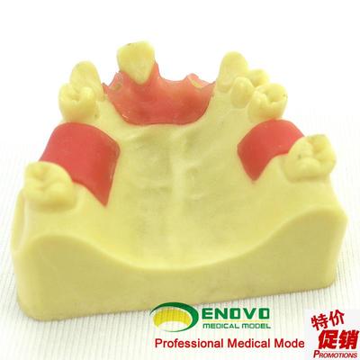 ENOVaO颐诺上颌缺失种植实训模型口腔即刻种植操作上颌骨缺失牙齿
