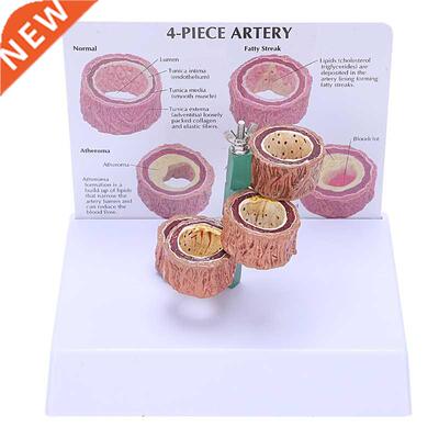Atherosclerosis Thrombosis Model Vascular Disease Demonstrat