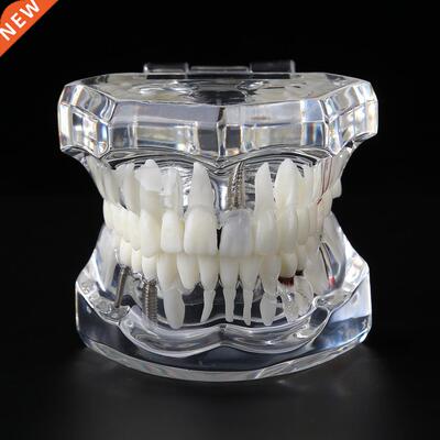 Dental Implant Disease Teeth Model With Restoration Bridge T