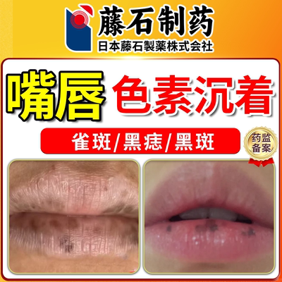 【嘴唇黑斑黑色素沉淀】药监备案