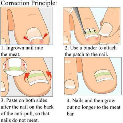 极速10Pcs/Set Naiml Art Ingrown Correction Sticker Fixer Pa