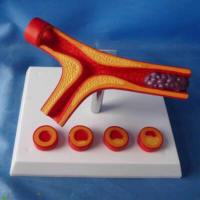 血管活动模型病态血栓血脂血管堵塞血液浓K度脂肪病理血液血管粥