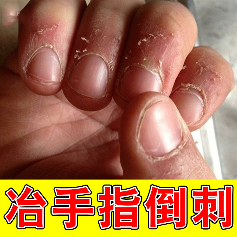 冶手指倒刺边缘表皮撕掉皮指甲边缘红肿软化剂甲干裂修护保湿乳霜