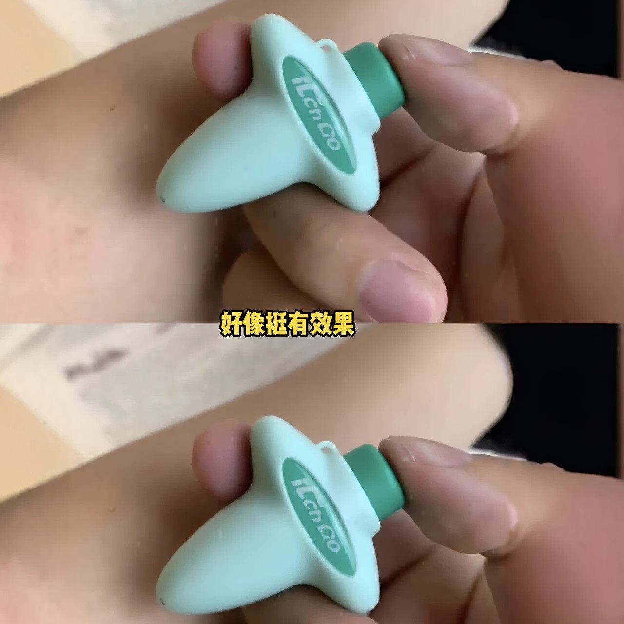 蚊虫叮咬止痒器夏季成人儿童户外露营便理止痒消肿器创意驱蚊神器