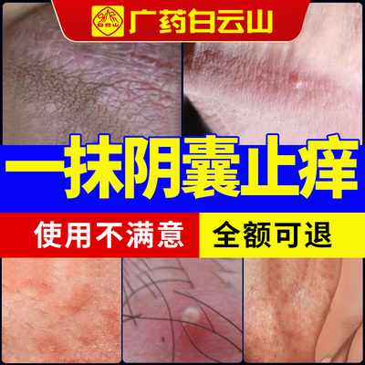 阴囊瘙痒湿疹止痒私处睾丸痒