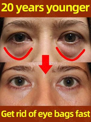 Creme dos círculos escuros e saco do olho, anti sacos nos o