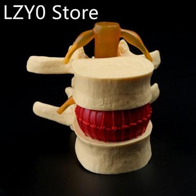 Anatomical Spine Lumbar Disc Herniation Anatomy Medical Teac