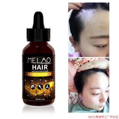 minoxidil hair growth serum anti loss slip scalp care头发液