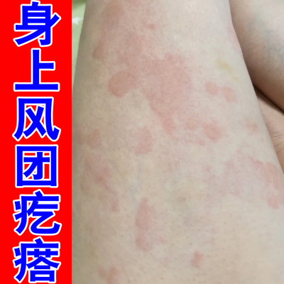 身上风团疙瘩皮肤痒老年人身上痒晚上痒的睡不着刺挠干燥掉屑草本