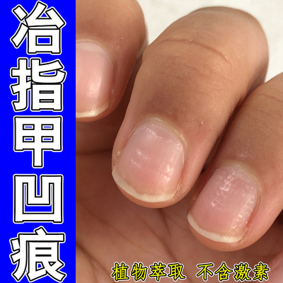 冶指甲凹痕甲萎缩甲分离凹凸不平专用甲增厚变黄甲黑线甲母痣草本