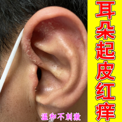 耳道发痒耳朵里面不舒服耳内干屑耳闷耳内发痒耳垢多耳部护理清洁