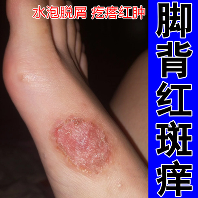 脚背红斑痒脚上红肿疙瘩粗糙掉屑起水泡泛红干燥痒鳞屑修护保湿药