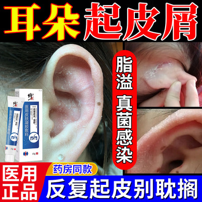 耳朵耳后起皮脂溢真菌感染膏