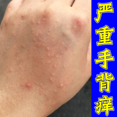 手背上起疙瘩痒天冷手上皮肤裂口流血干痒专用修复膏
