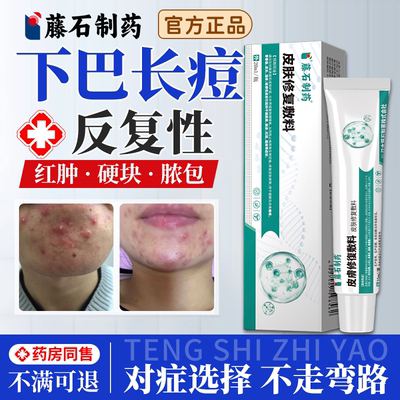 【日本监制】下巴反复长痘腮边痘