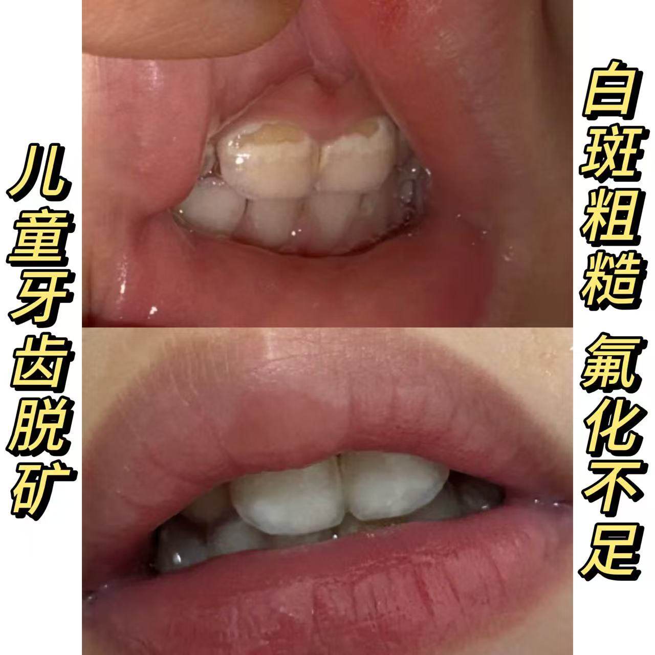 儿童牙齿脱矿白斑钙化专用牙膏涂氟护牙素含氟青少年牙釉质修复OZ