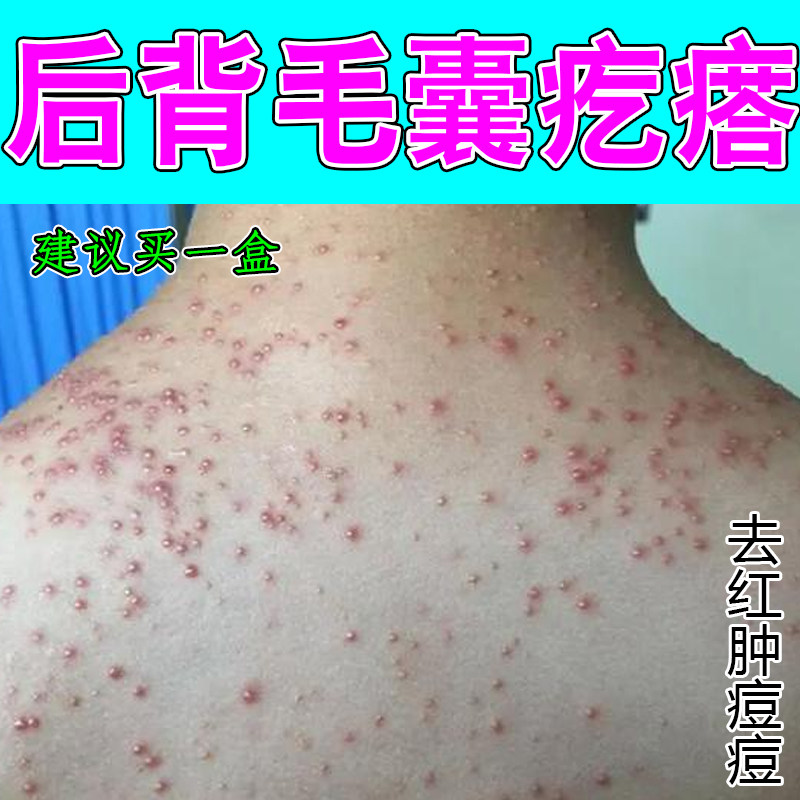 后背毛囊疙瘩脓包红肿痘马拉色菌毛囊堵塞上火熬夜内分泌失调感染