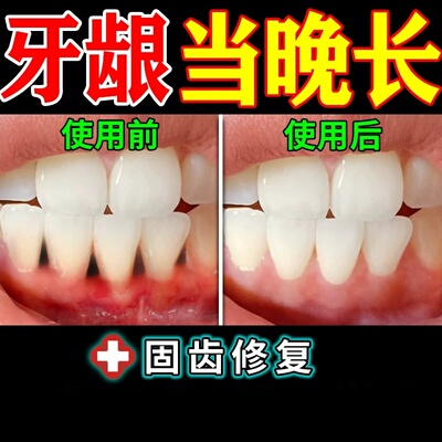 牙龈萎缩修复生再专用牙治牙齿松动黑三角牙龈萎缩喷雾剂