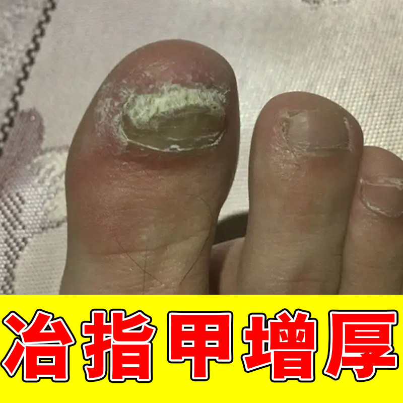 脚趾甲增厚变黄空黑白手指甲甲肉分离修复脚趾甲净脱厚甲专用