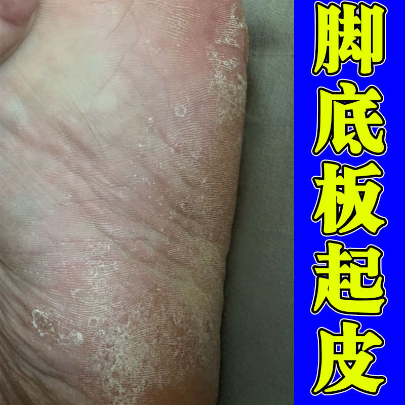 脚干裂足跟脚后跟干燥开裂脚脱皮掉皮角质层太厚去老茧干皮