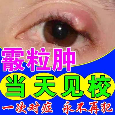 霰粒肿热敷眼贴眼睑板腺疏通眼睛模糊儿童眼皮红肿痒麦粒肿散粒肿