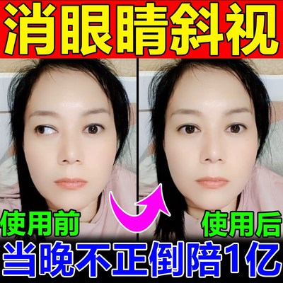 速发眼睛斜视矫正训器练器聚正球纠散内外弱视斗鸡眼歪矫正儿童眼