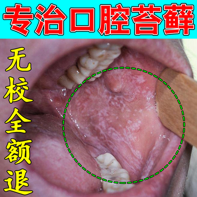 口腔扁平苔藓专用的药治疗黏膜修复液口腔纤维化溃疡灼口综合症药