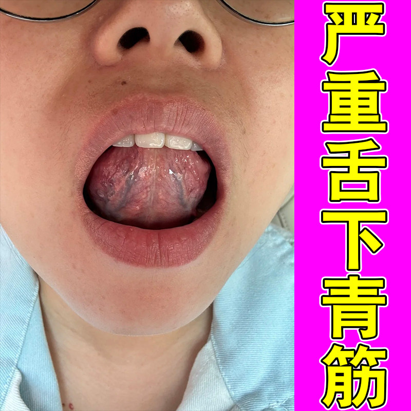 舌下青筋又黑又粗大淤血疏通舌头底冷黑紫血管严重怒张增疏通喷剂