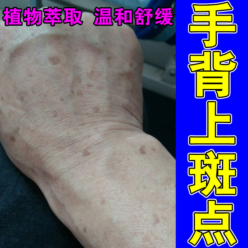 身上脸上斑手部面部暗沉成年人黑斑晒斑脸上暗沉修护膏