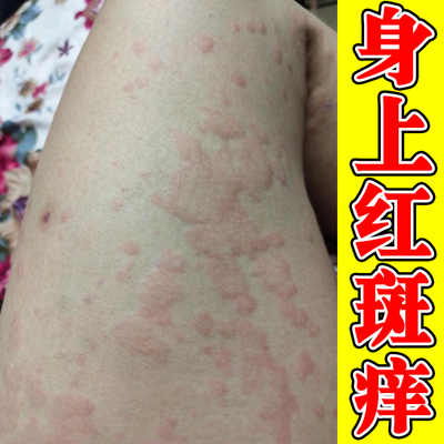 身上痒起红疙瘩风团红斑皮肤痒大腿内侧过敏股长小红点干燥痒专用